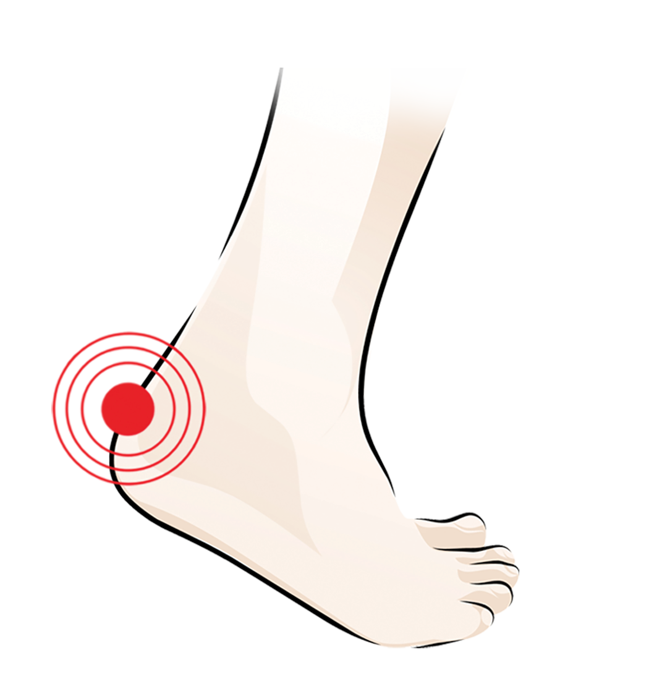 Childrens Heel Pain (Sever's Disease) | Footlogics Orthotics
